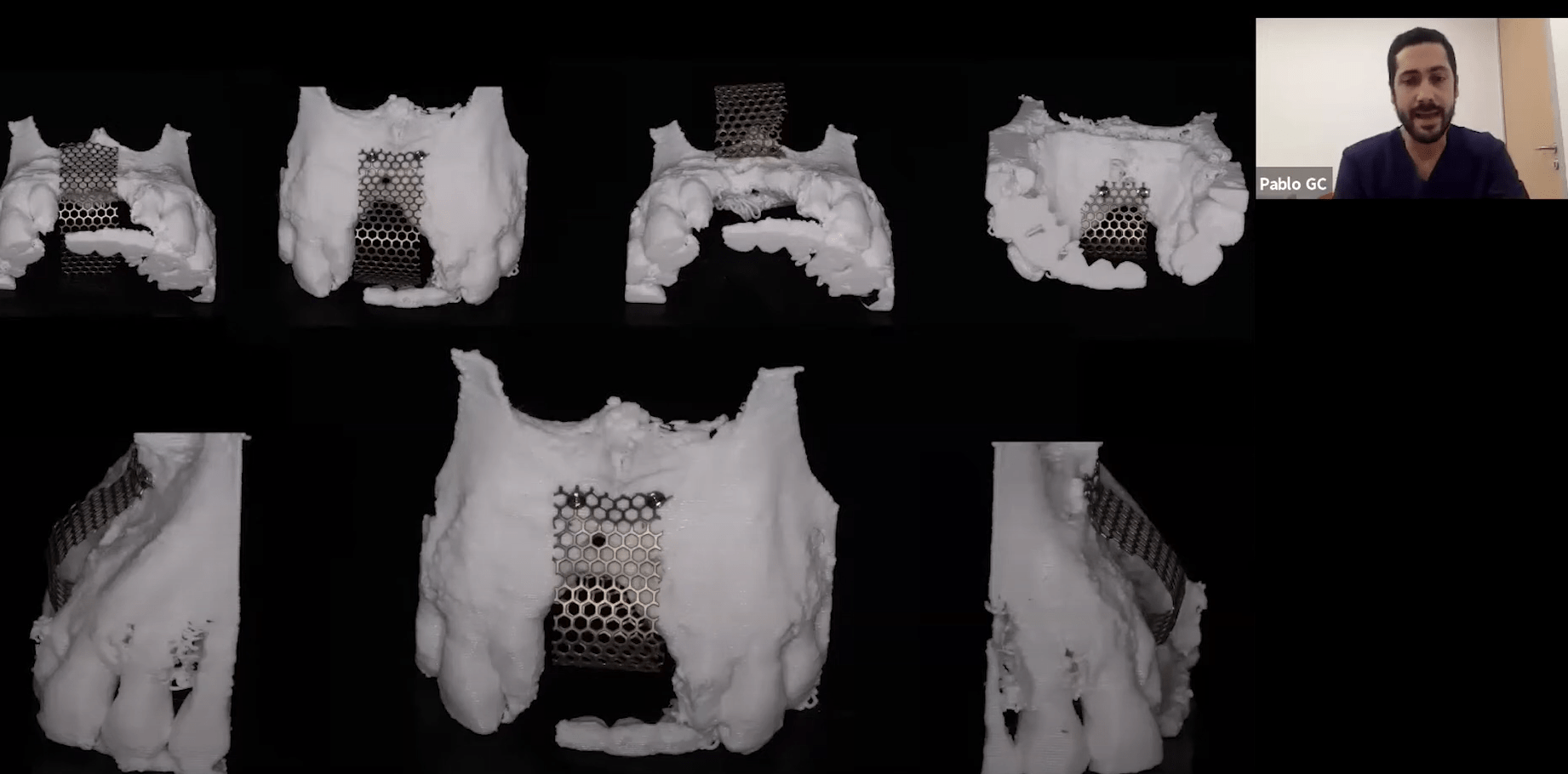 SEPA 2020 ON AIR: Clinical application of titanium mesh in bone ...